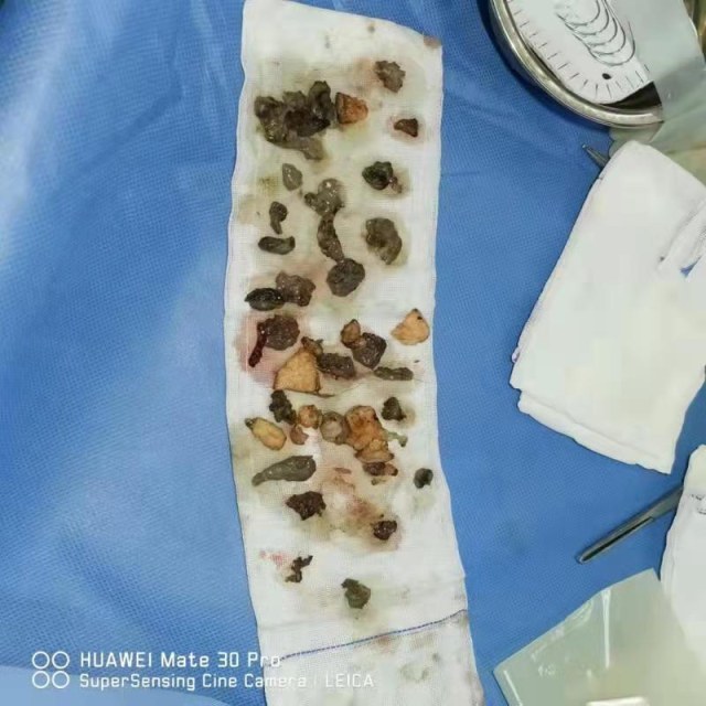 因为一个小小的局部感染灶 宁波大伯患上坏死性筋膜炎 国科大华美医院多学科团队齐心战胜这一让杭州网红